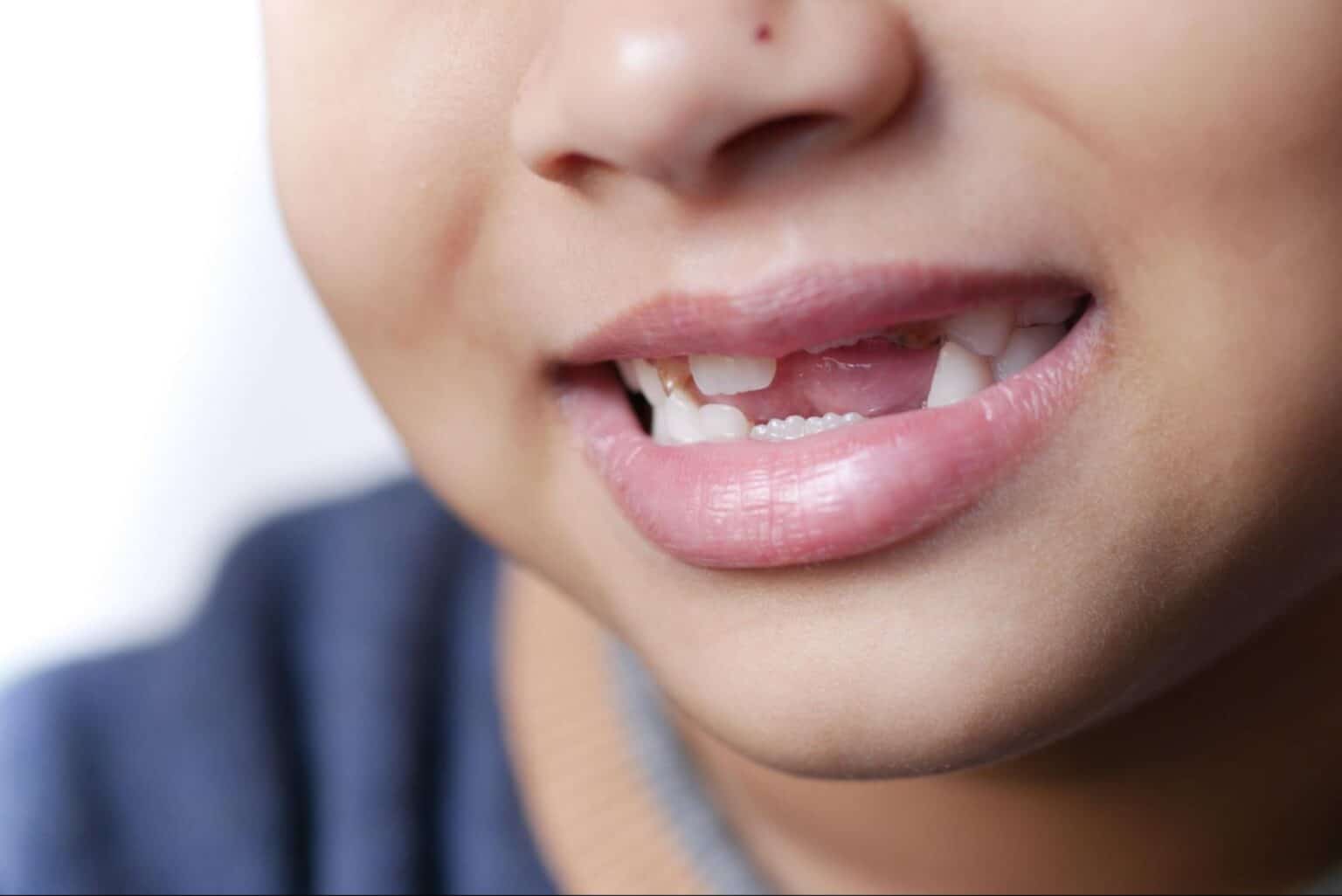 Qué es la agenesia dental, cuáles son los tipos, sus causas y su ...
